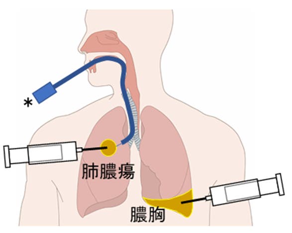肺膿瘍・膿胸の菌が口腔内細菌に由来することを遺伝子解析で証明口腔内の菌が他臓器に感染症を起こし得ることの初の証明～研究成果が米国細菌学会誌 ...